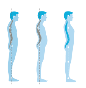The Impact of Posture and Positioning With Hypermobility